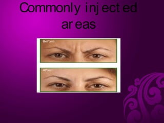 BOTOX AT CHENNAI PLASTIC SURGERY | PPT