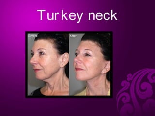 BOTOX AT CHENNAI PLASTIC SURGERY | PPT