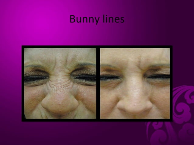 BOTOX AT CHENNAI PLASTIC SURGERY | PPT
