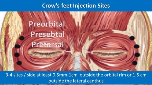 ADVANCED BOTOX COURSE.PART II. HOW TO INJECT BOTOX SAFELY? | PPSX ...