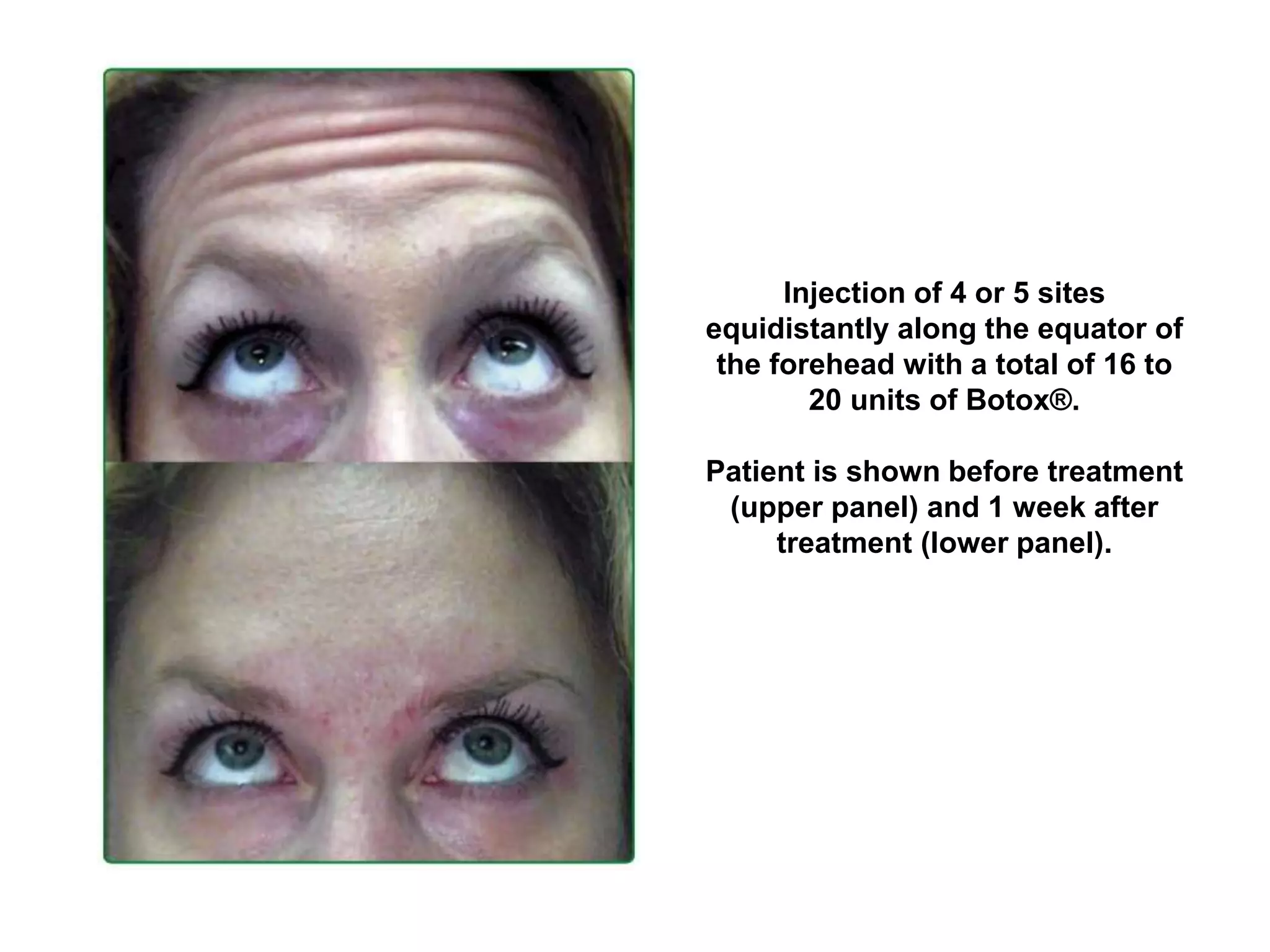 Botulinum Toxin A (BOTOX) | PPTX