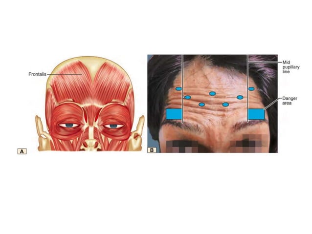 Botulinum Toxin A (BOTOX) | PPTX