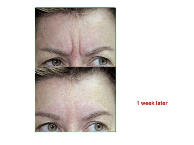 Botulinum Toxin A (BOTOX) | PPTX
