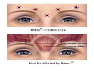 Botox.pptx
