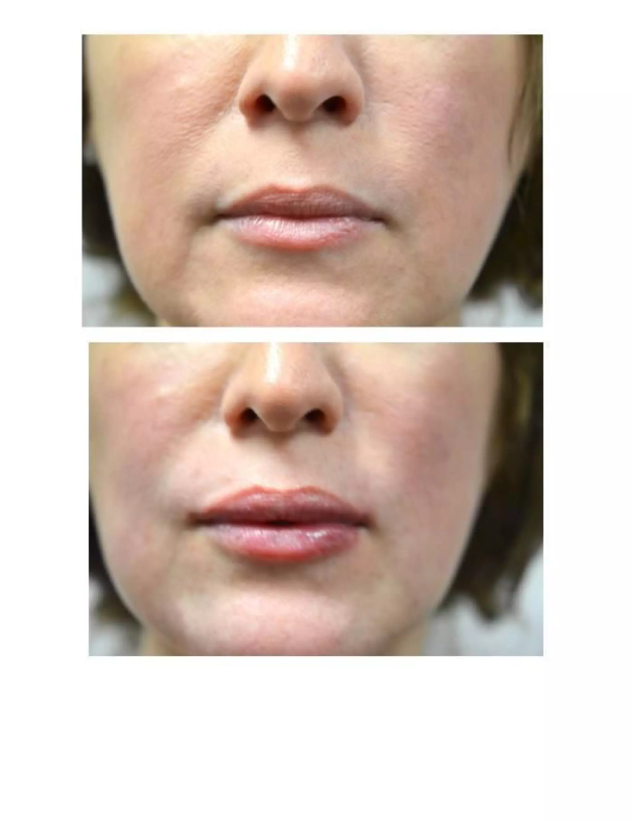 Botox and fillers | PDF