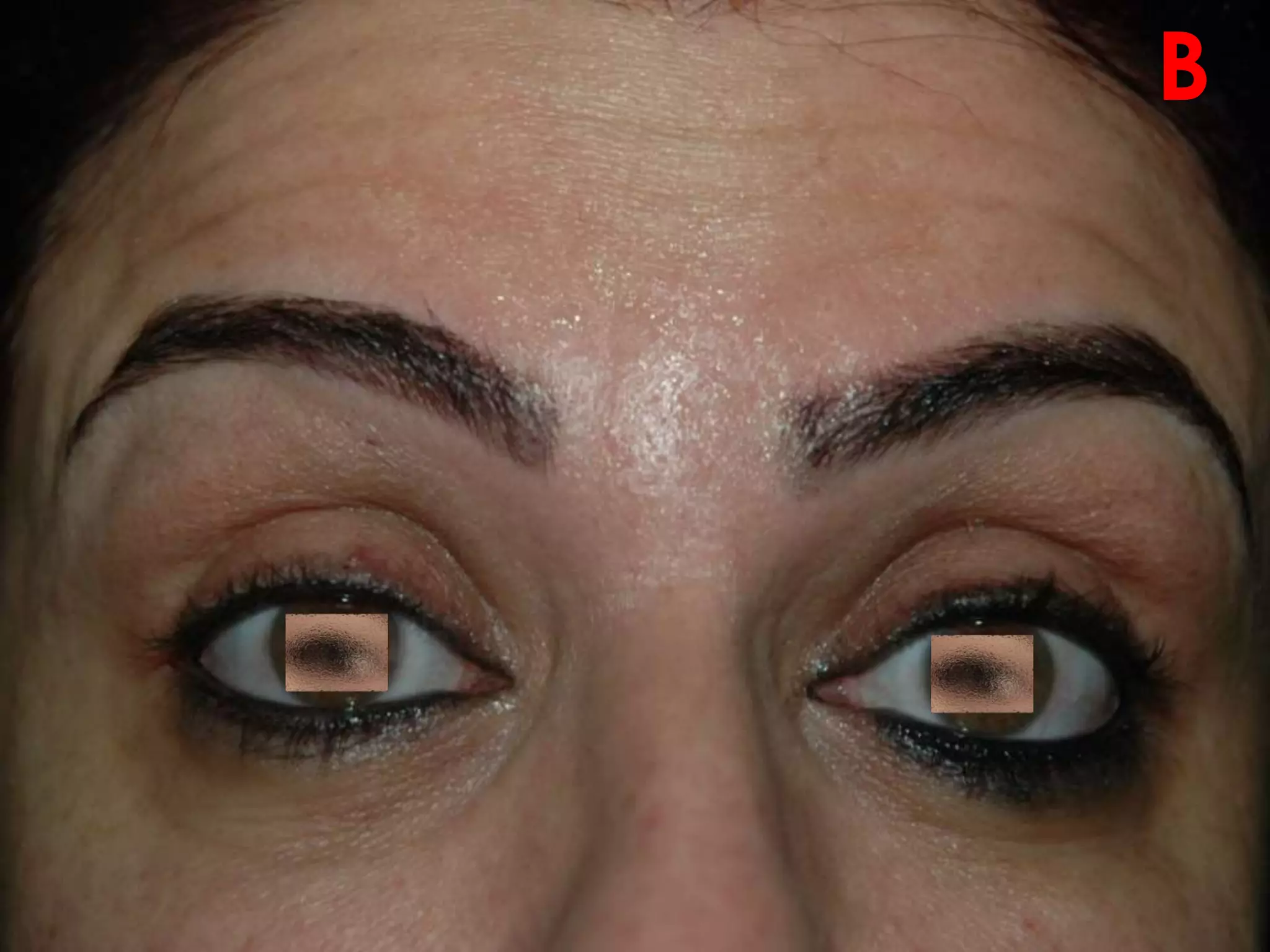 The Art of Liquid Face Lift (Botox) | PPSX | Skin Care | Beauty