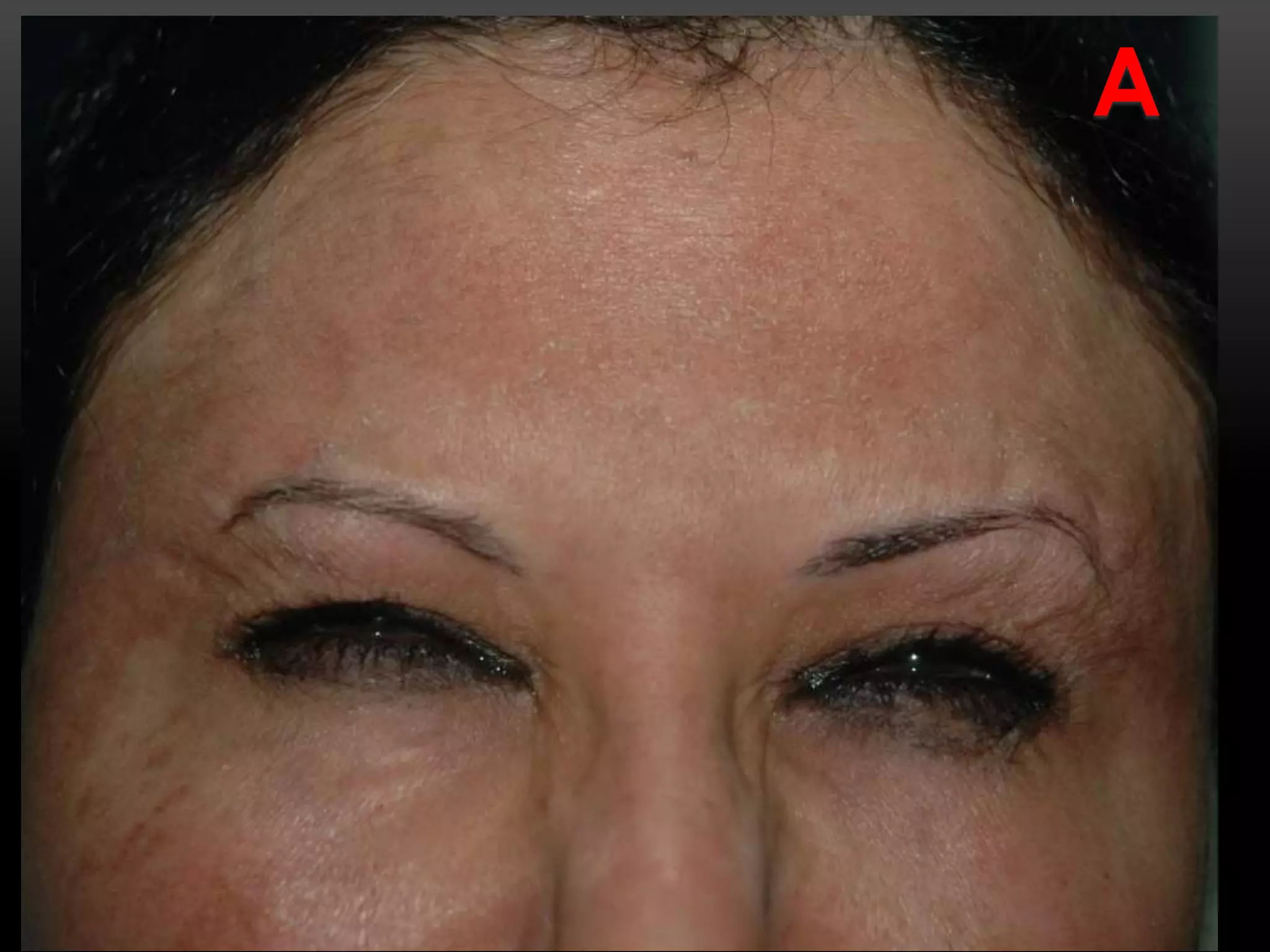 The Art of Liquid Face Lift (Botox) | PPSX | Skin Care | Beauty