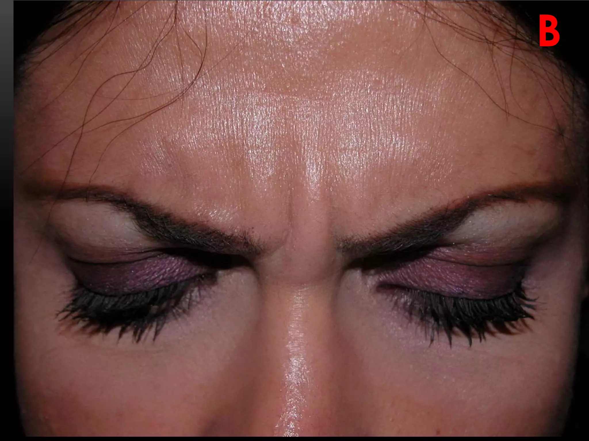 The Art of Liquid Face Lift (Botox) | PPSX | Skin Care | Beauty