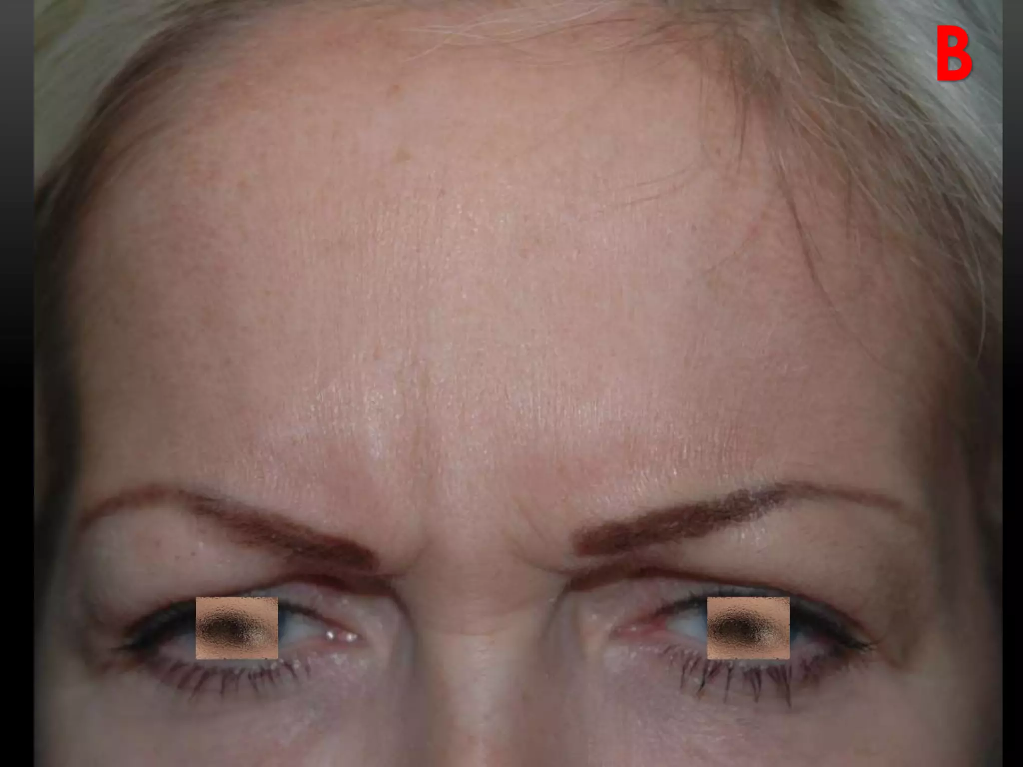 The Art of Liquid Face Lift (Botox) | PPSX | Skin Care | Beauty