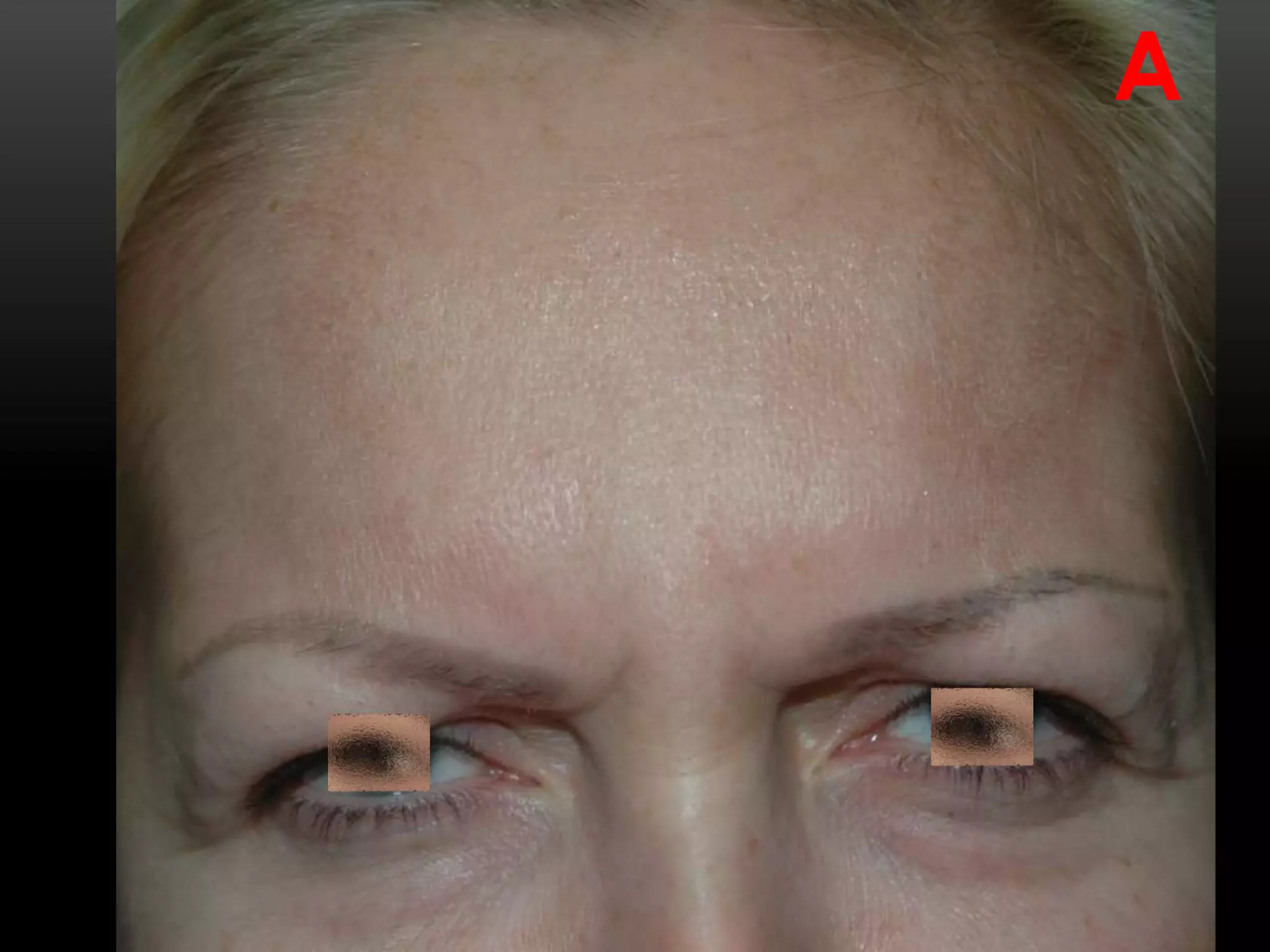 The Art of Liquid Face Lift (Botox) | PPSX | Skin Care | Beauty