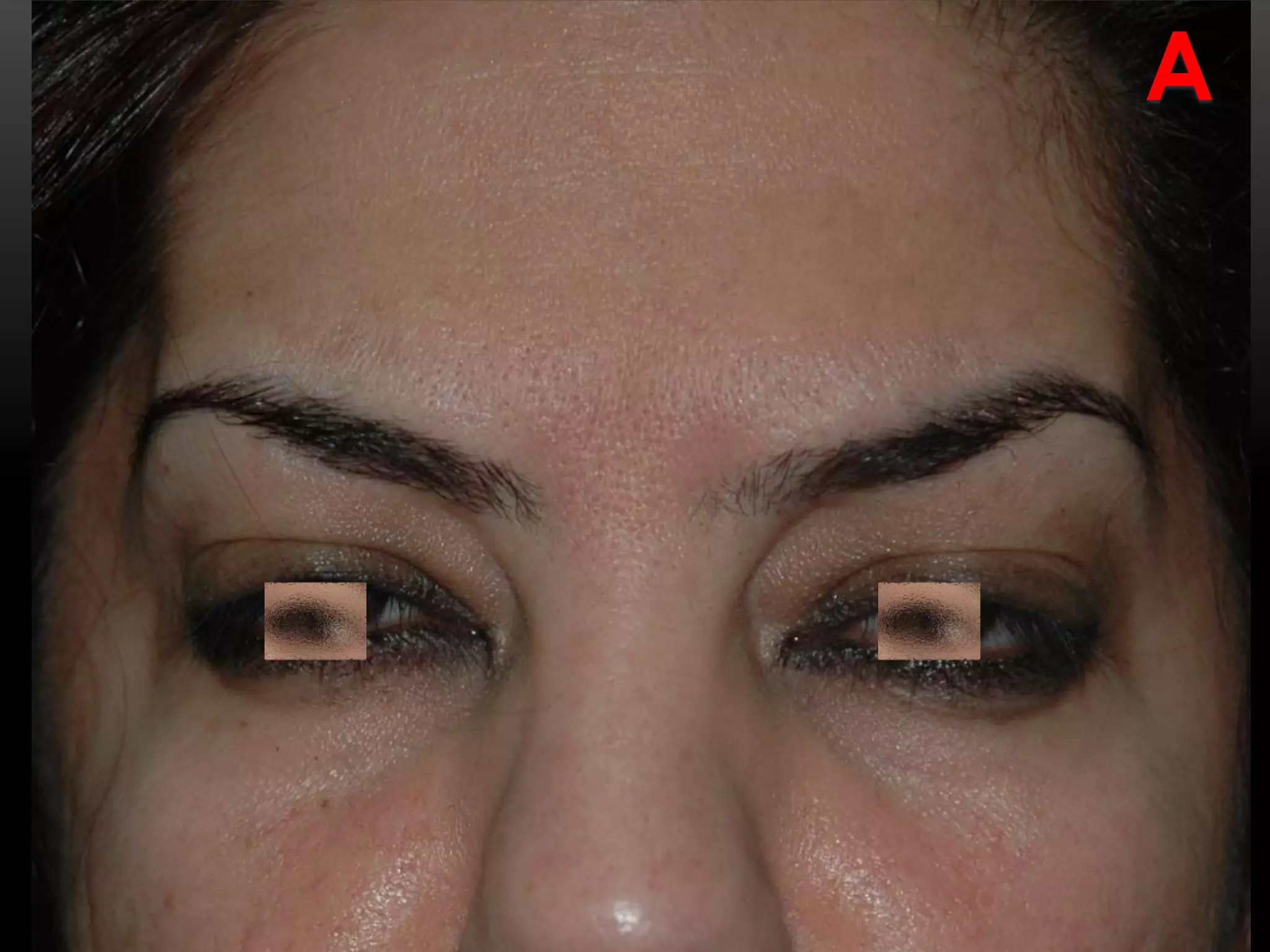 The Art of Liquid Face Lift (Botox) | PPSX | Skin Care | Beauty