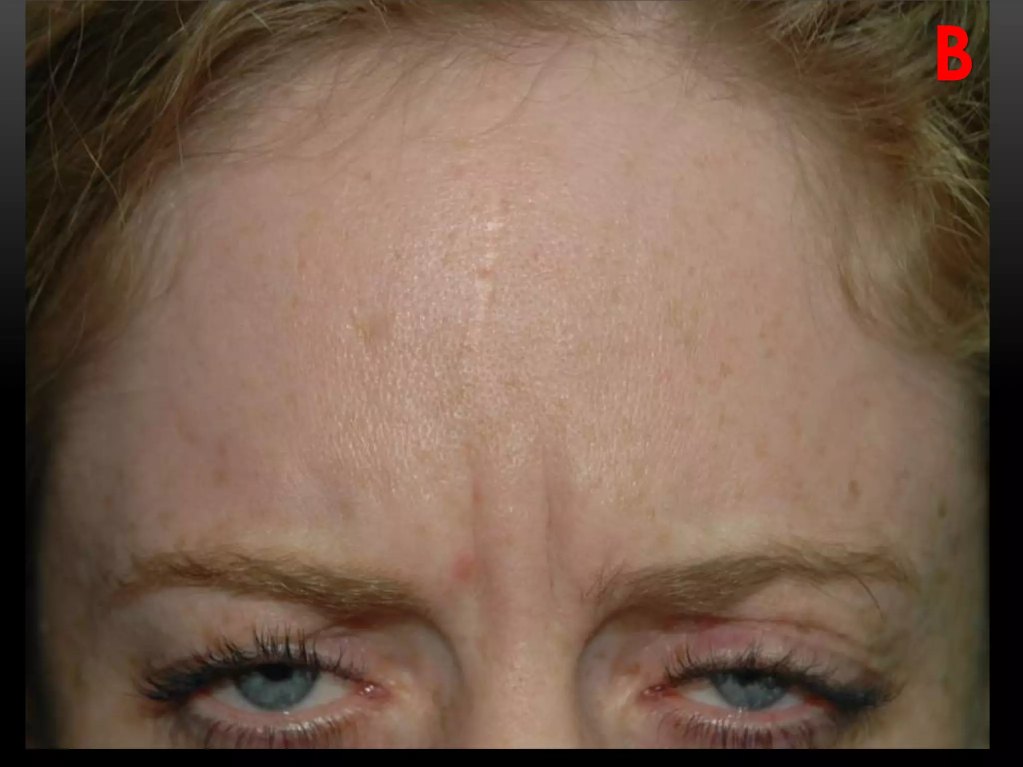 The Art of Liquid Face Lift (Botox) | PPSX | Skin Care | Beauty