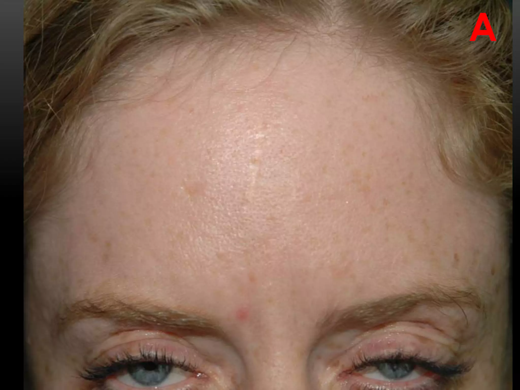 The Art of Liquid Face Lift (Botox) | PPSX | Skin Care | Beauty