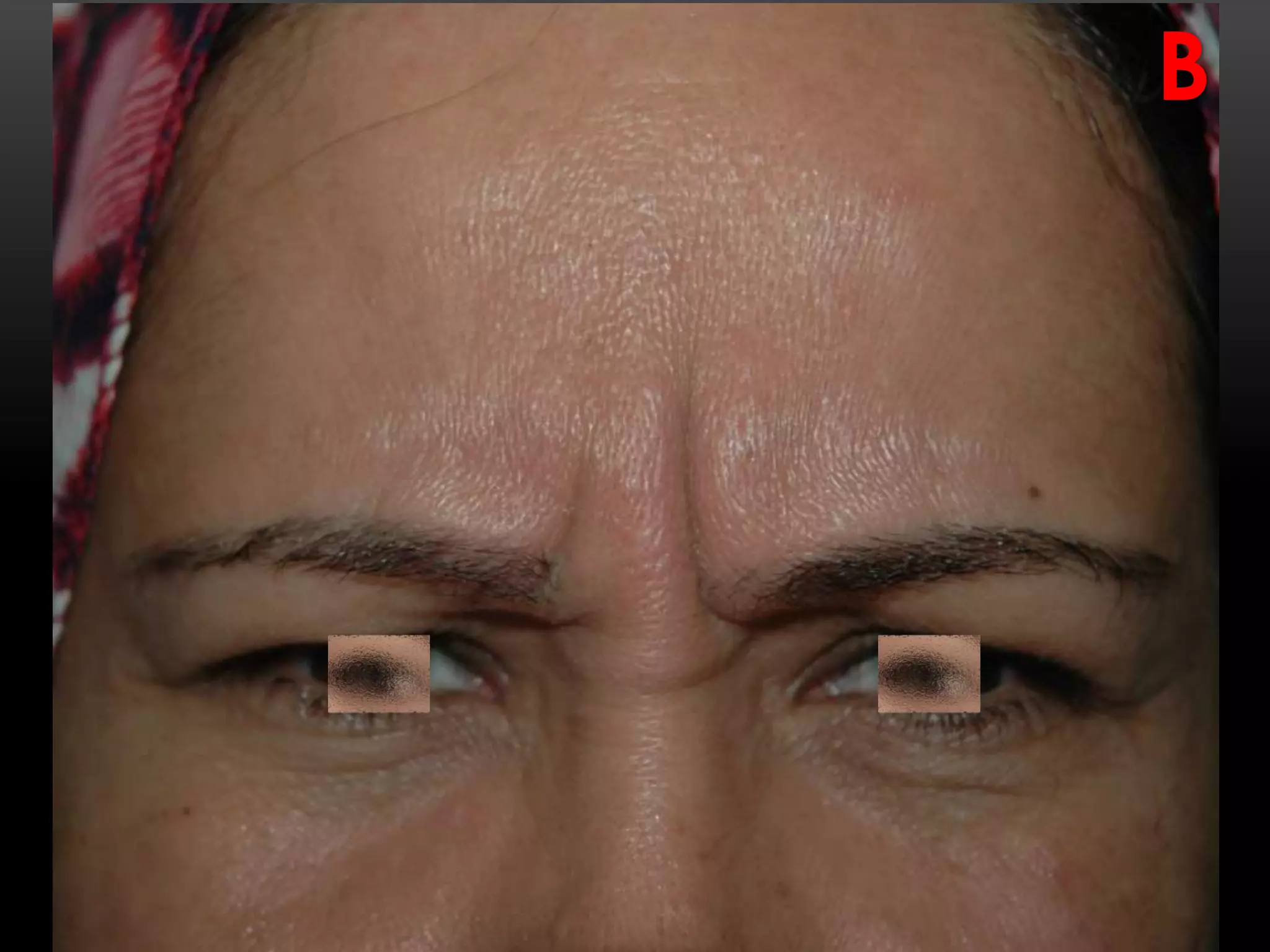 The Art of Liquid Face Lift (Botox) | PPSX