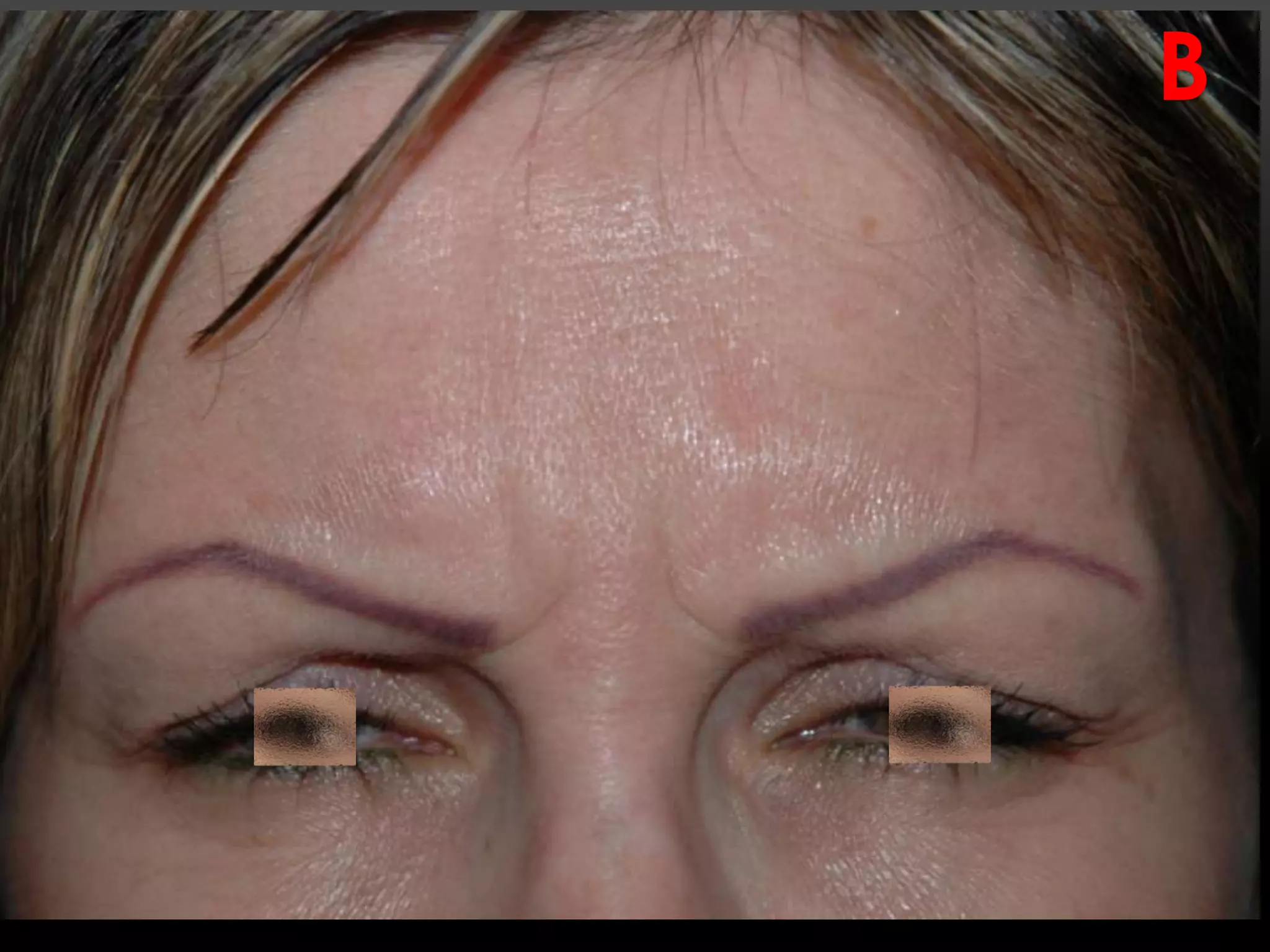 The Art of Liquid Face Lift (Botox) | PPSX | Skin Care | Beauty