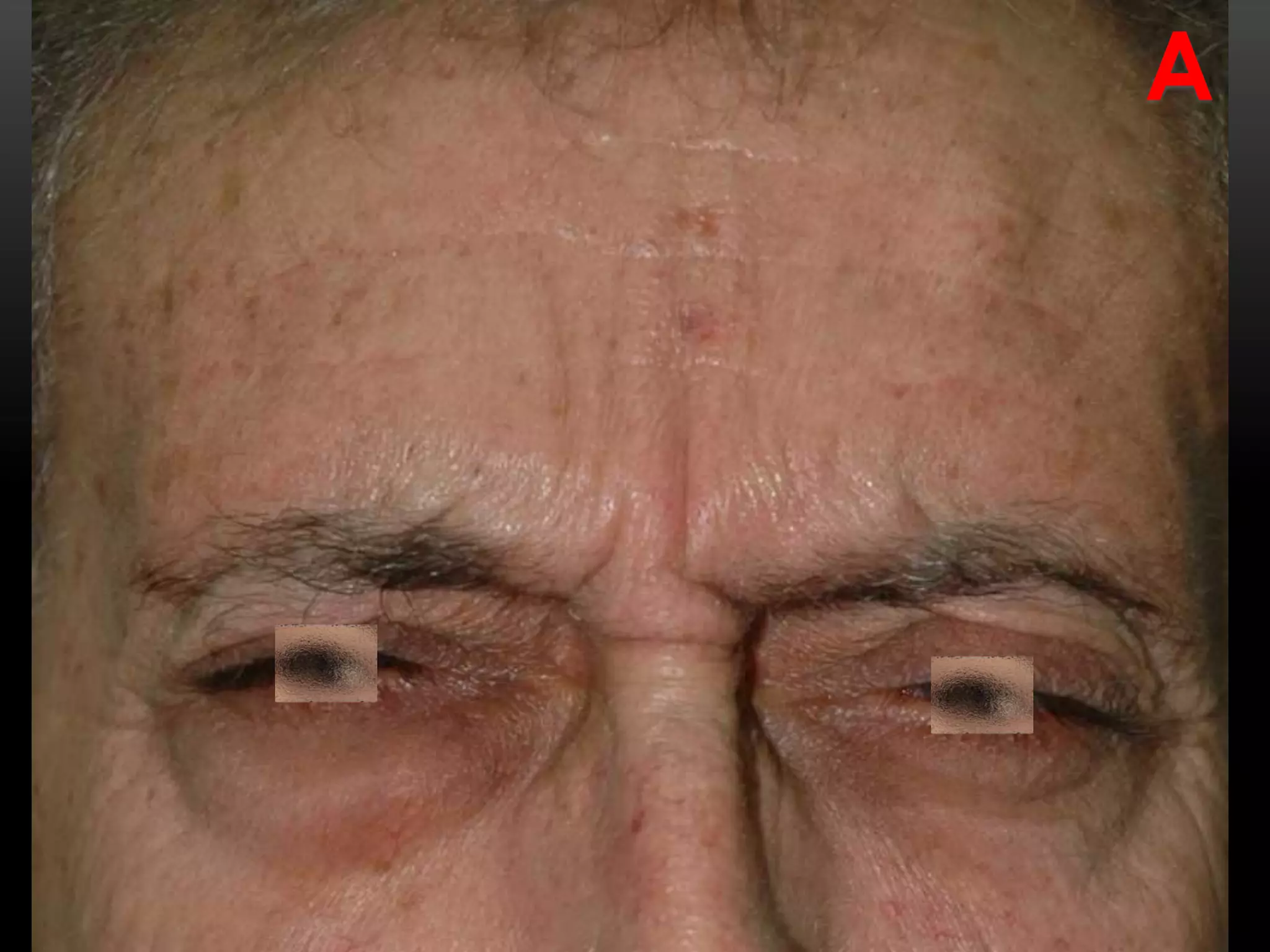 The Art of Liquid Face Lift (Botox) | PPSX | Skin Care | Beauty