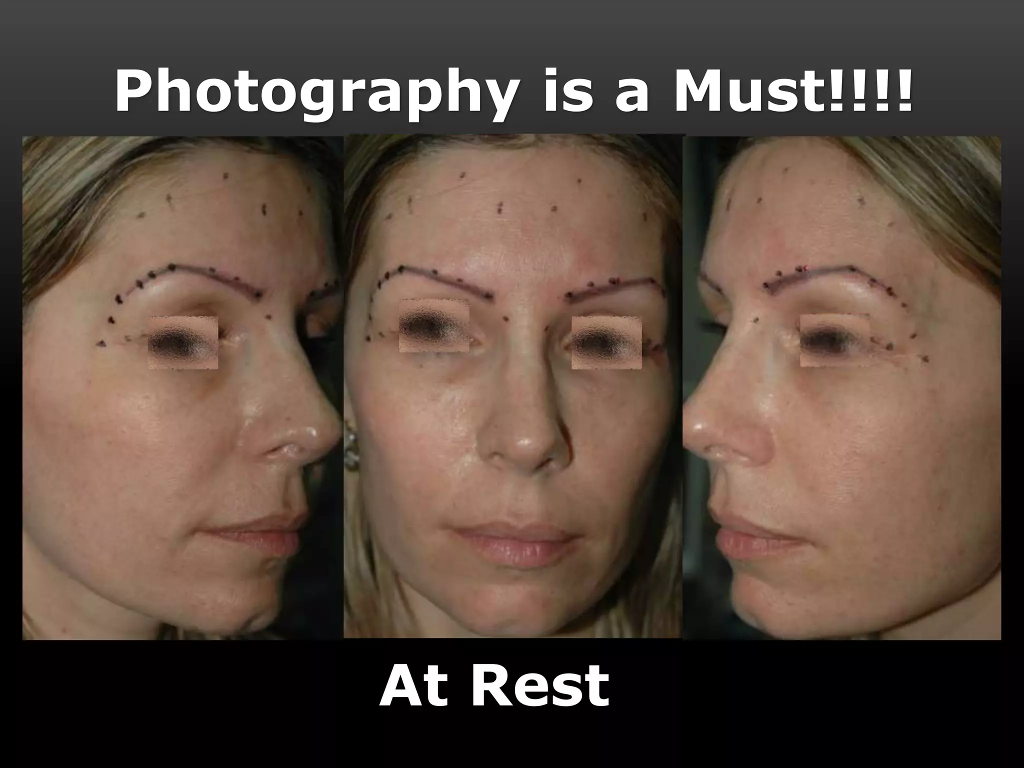 The Art of Liquid Face Lift (Botox) | PPSX | Skin Care | Beauty