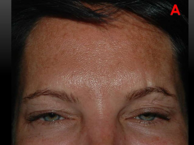 The Art of Liquid Face Lift (Botox) | PPSX | Skin Care | Beauty