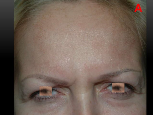 The Art of Liquid Face Lift (Botox) | PPSX | Skin Care | Beauty