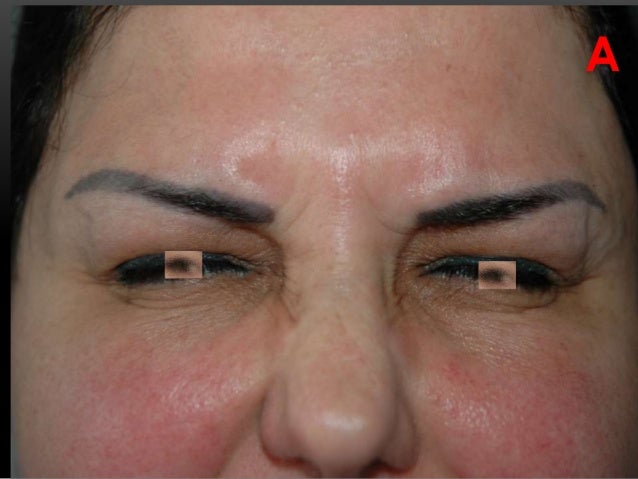 The Art of Liquid Face Lift (Botox)