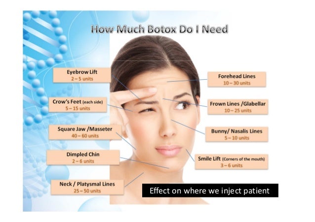 Botox and its effect on the Brain