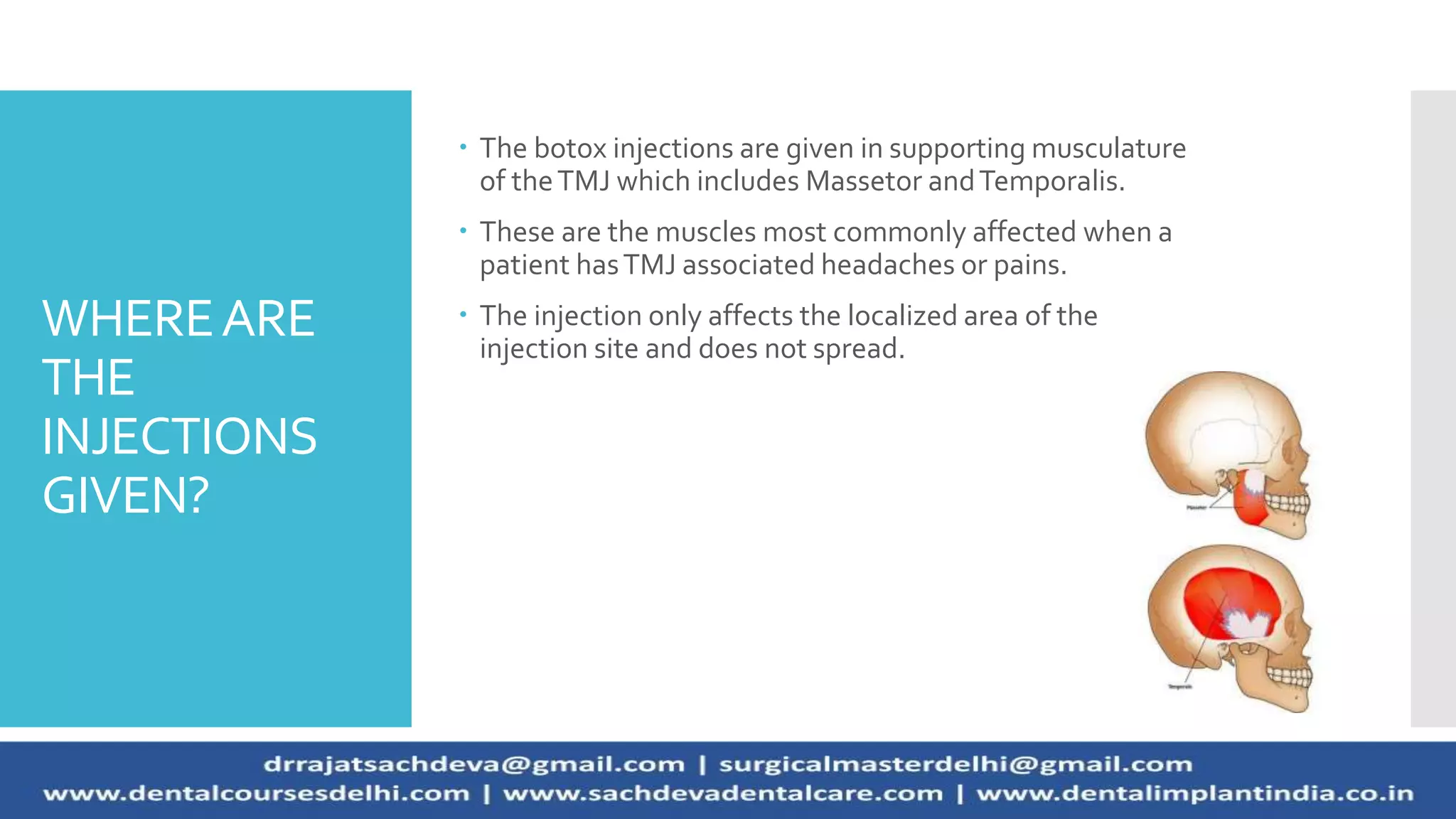 Botox for your TMJ (tempero mandibular joint) by Dr.Rajat Sachdeva ...