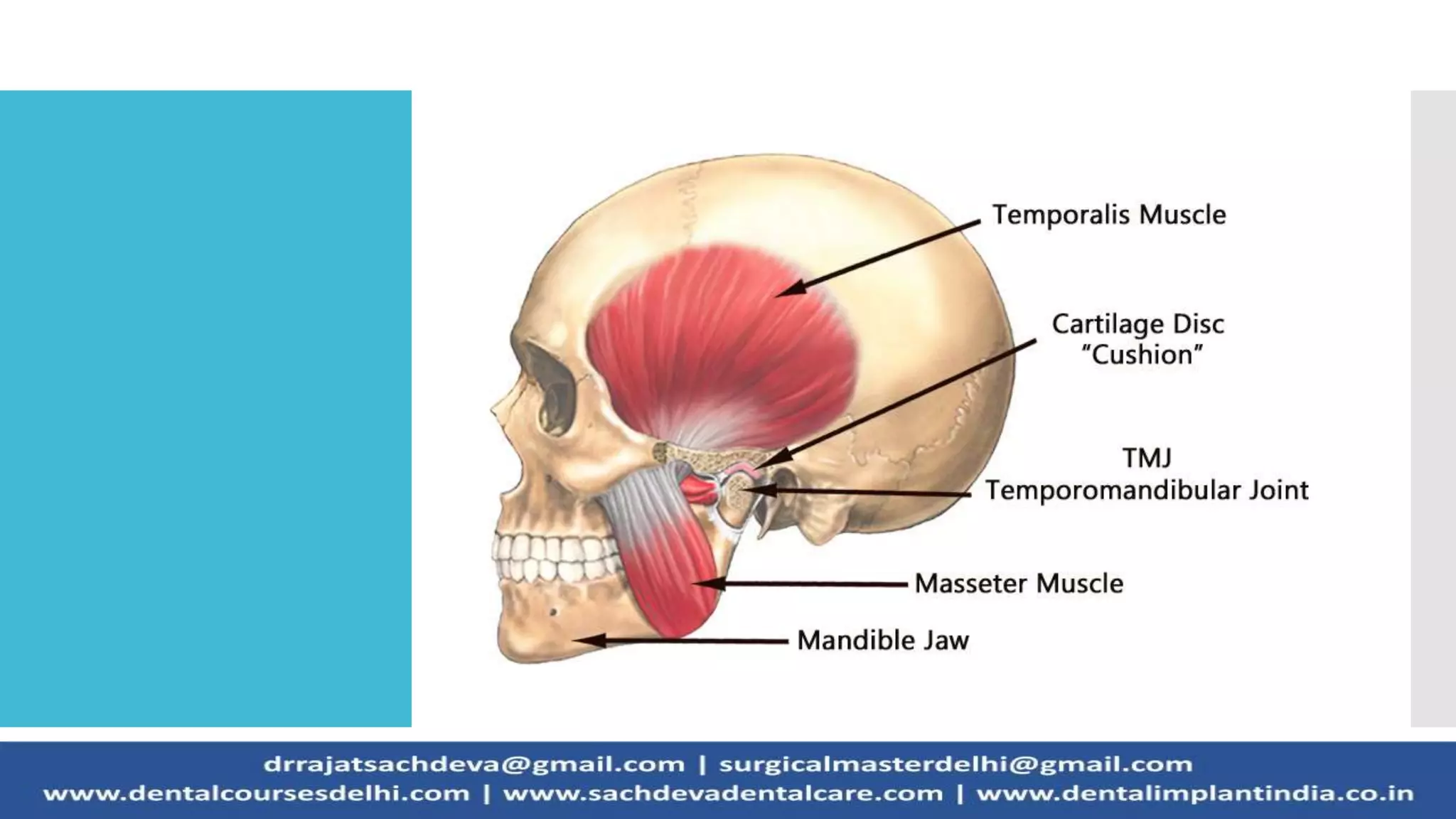 Botox for your TMJ (tempero mandibular joint) by Dr.Rajat Sachdeva ...