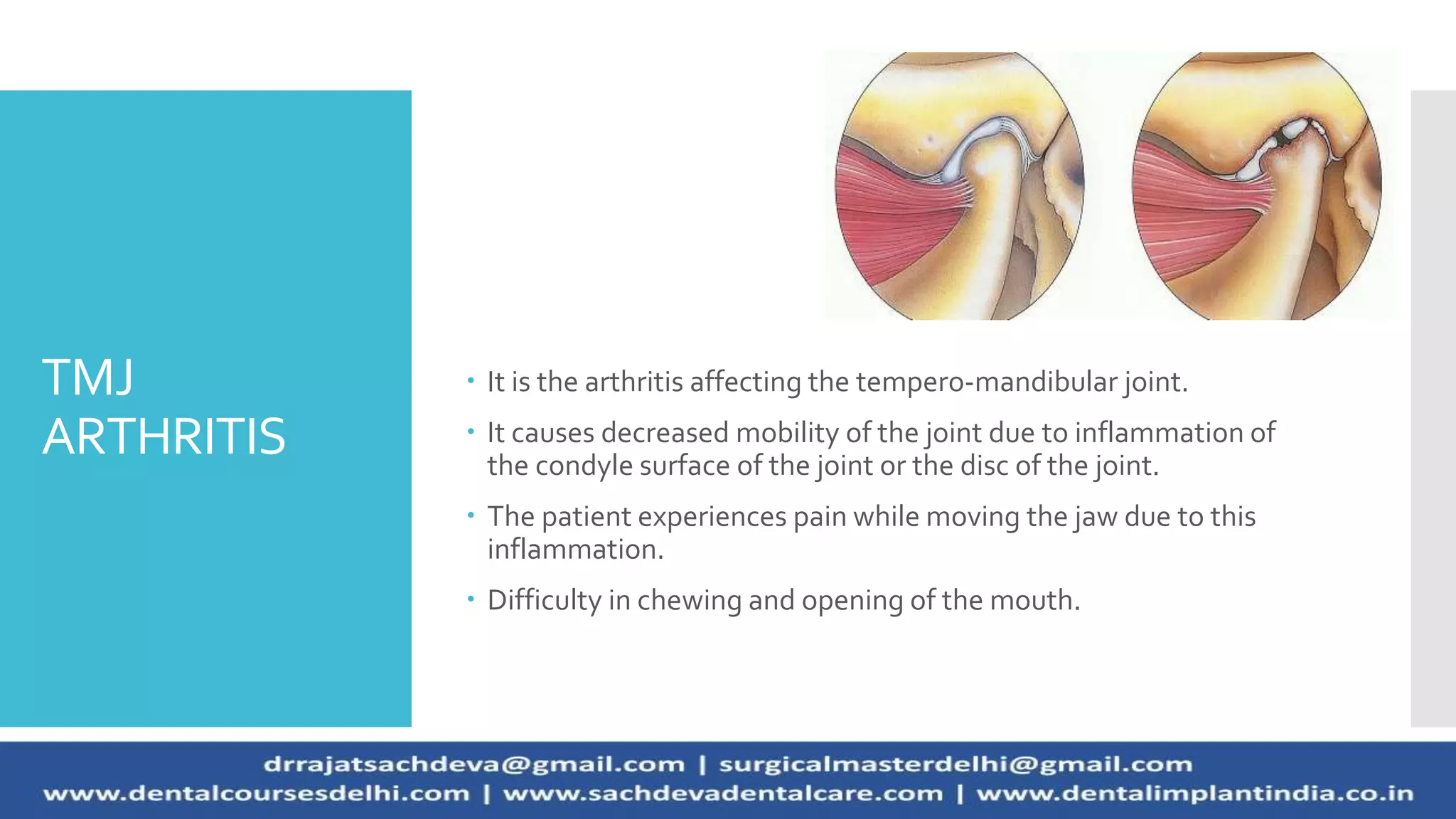 Botox for your TMJ (tempero mandibular joint) by Dr.Rajat Sachdeva ...