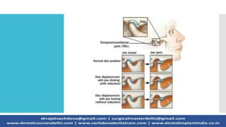 Botox for your TMJ (tempero mandibular joint) by Dr.Rajat Sachdeva ...