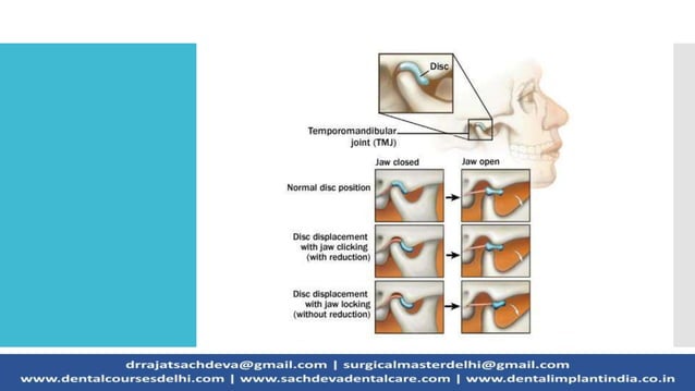 Botox for your TMJ (tempero mandibular joint) by Dr.Rajat Sachdeva ...