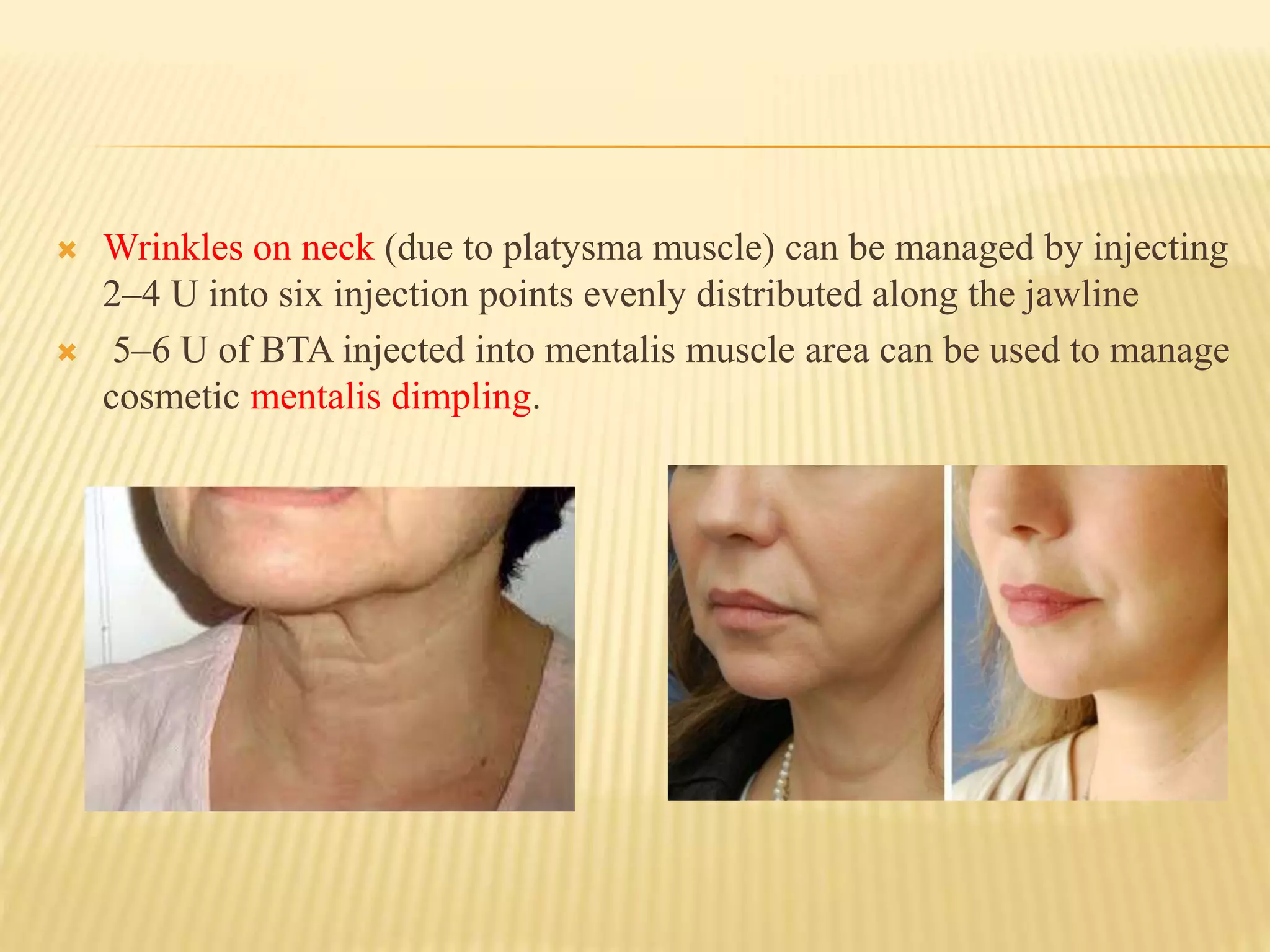 Botulinum toxin and its application in omfs | PPTX