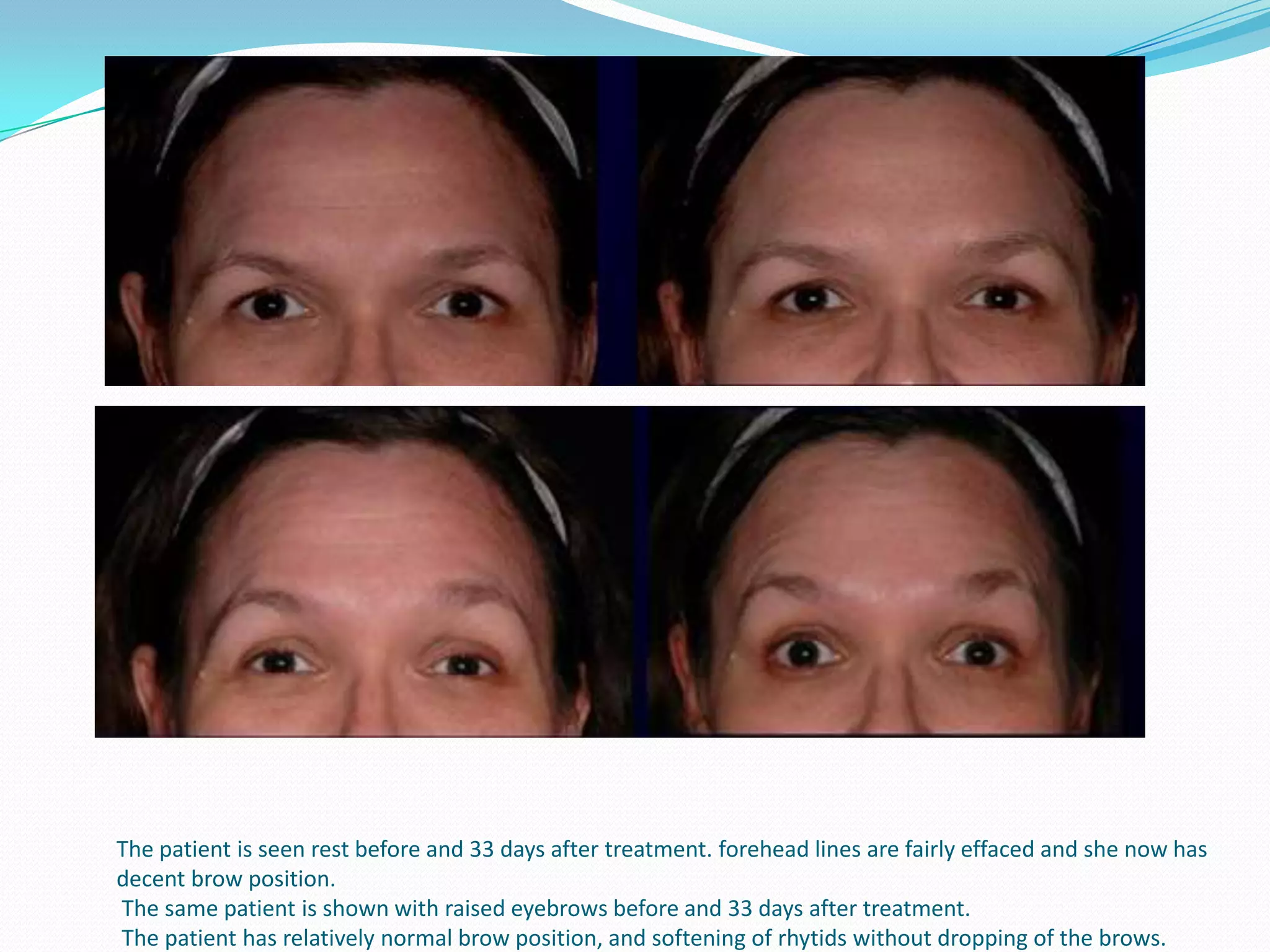 Botulinum toxin in dermatology ppt | PPTX