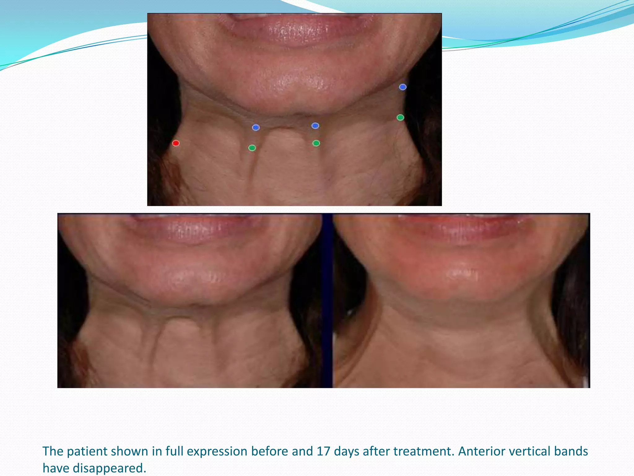 Botulinum toxin in dermatology ppt | PPTX