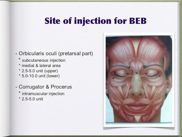 Botulinum toxin in neuro oph