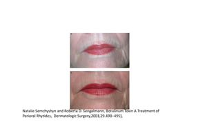 BOTULINUM Toxin lower face- Dr Rabia Ghafoor.pdf