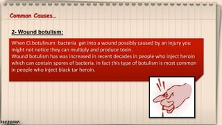 Botulism | PPTX