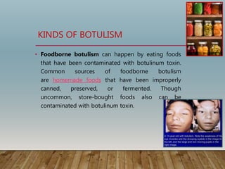 Botulism-Epi.pptx