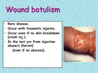 Wound Botulism