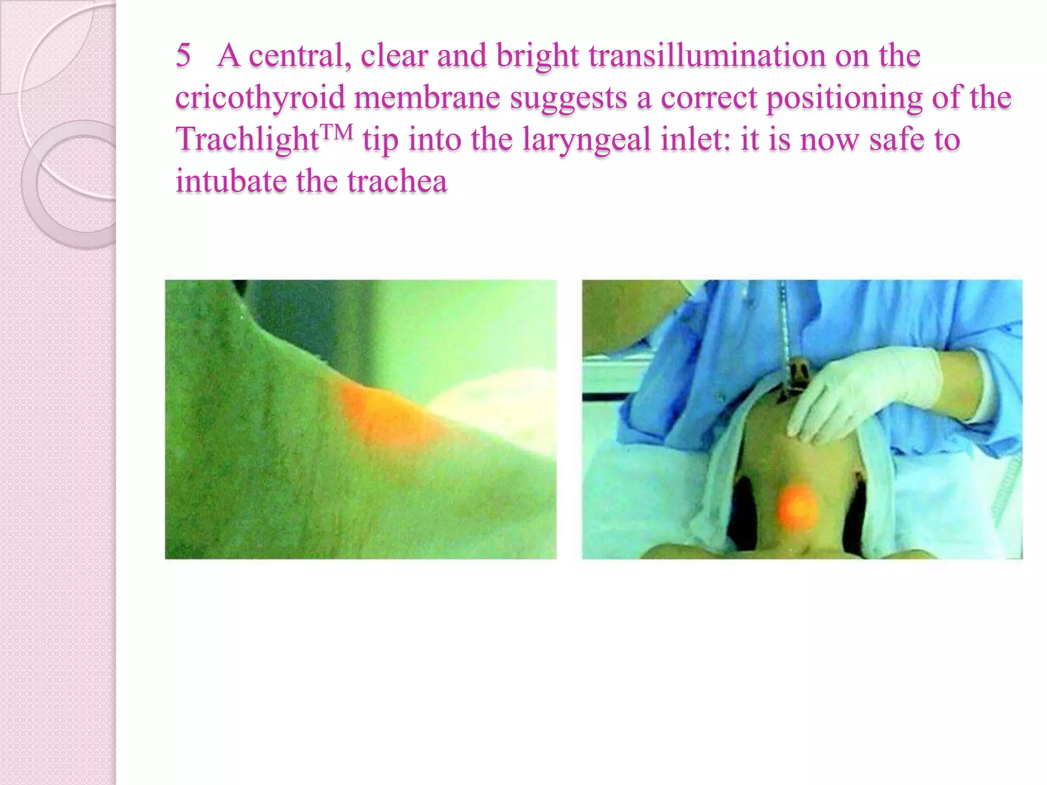 Bougie, trachlite , laryngeal tube , combitube , i gel ,truview | PPTX