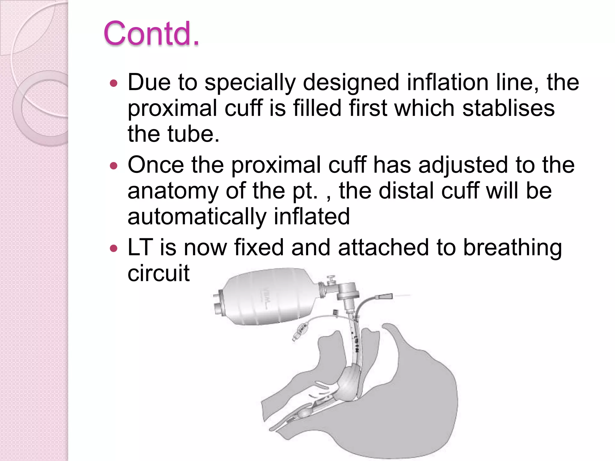 Bougie, trachlite , laryngeal tube , combitube , i gel ,truview | PPTX