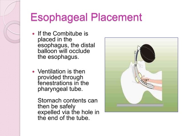 Bougie, trachlite , laryngeal tube , combitube , i gel ,truview | PPTX ...