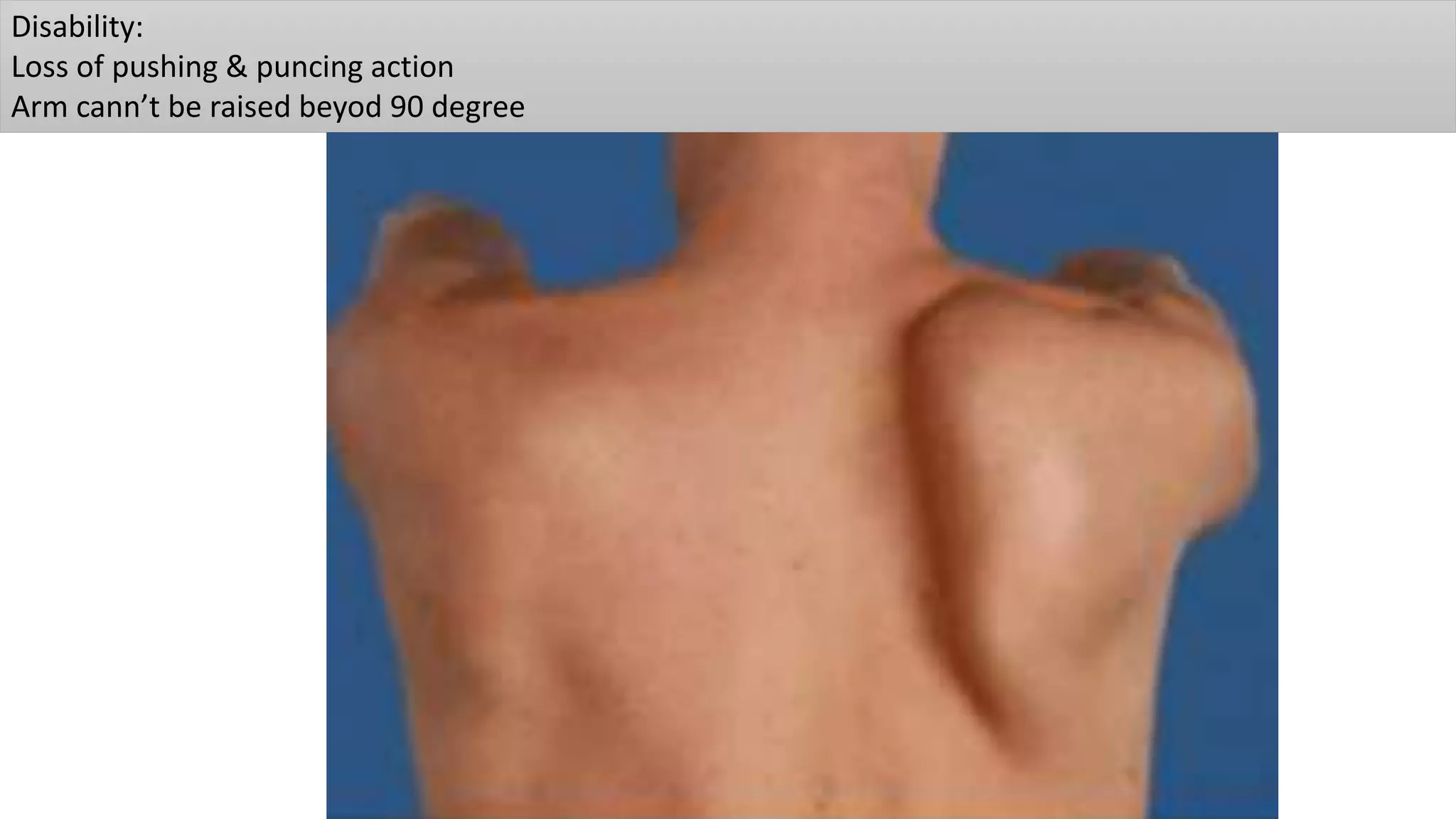 Boundaries & contents of Axilla | PPTX