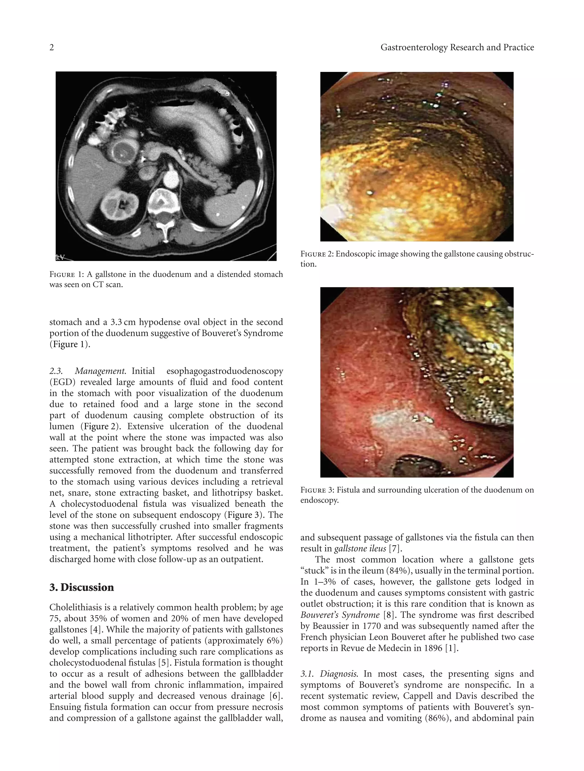 Bouveret’s syndrome case report and review of the literature | PDF