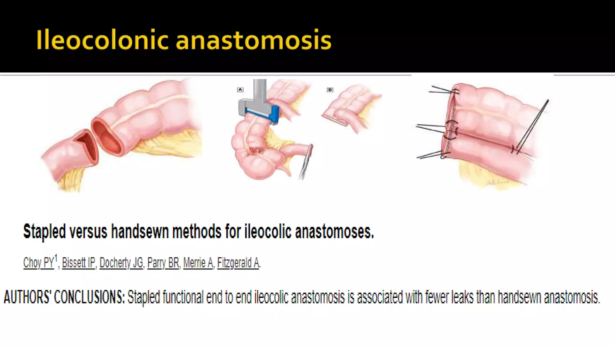 Bowel anastomosis | PPTX