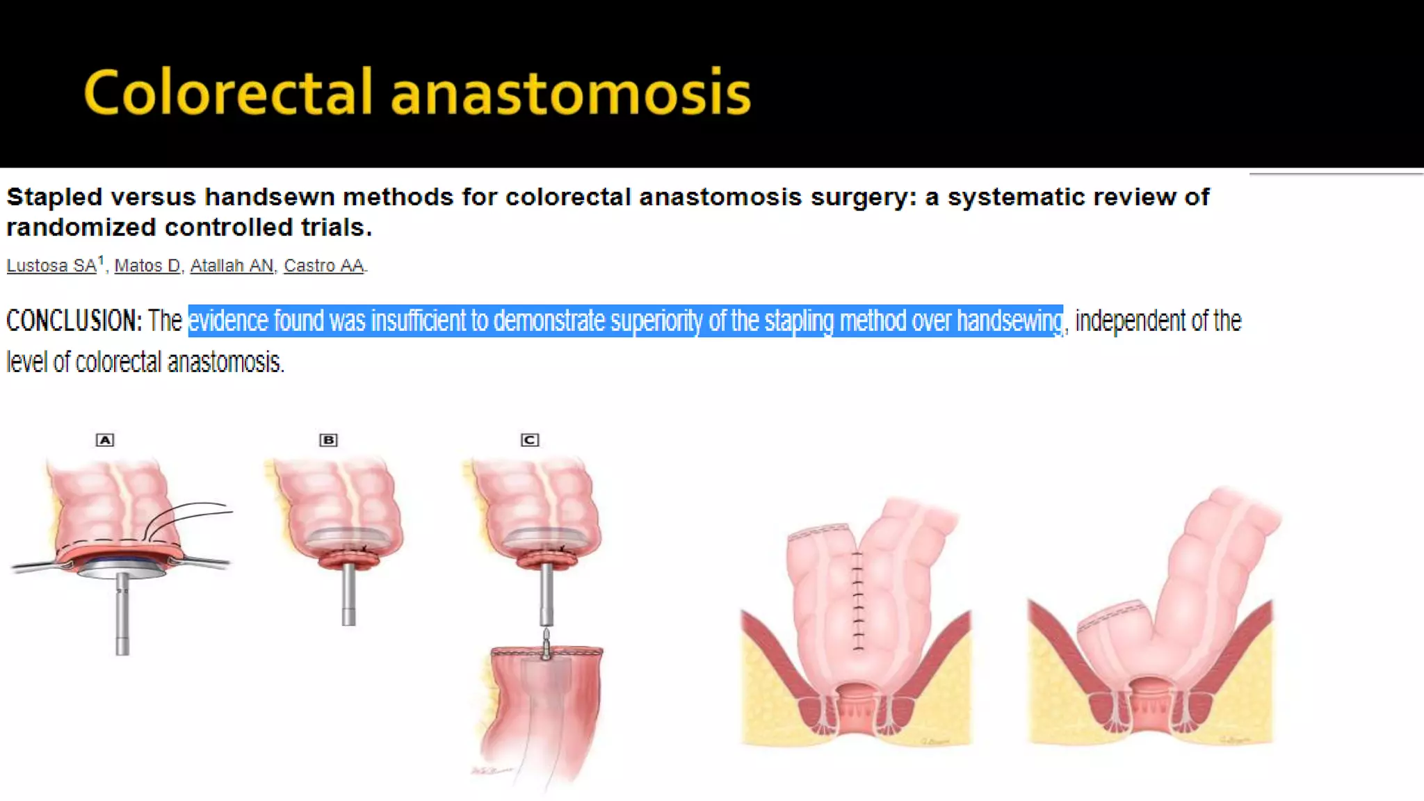 Bowel anastomosis | PPTX