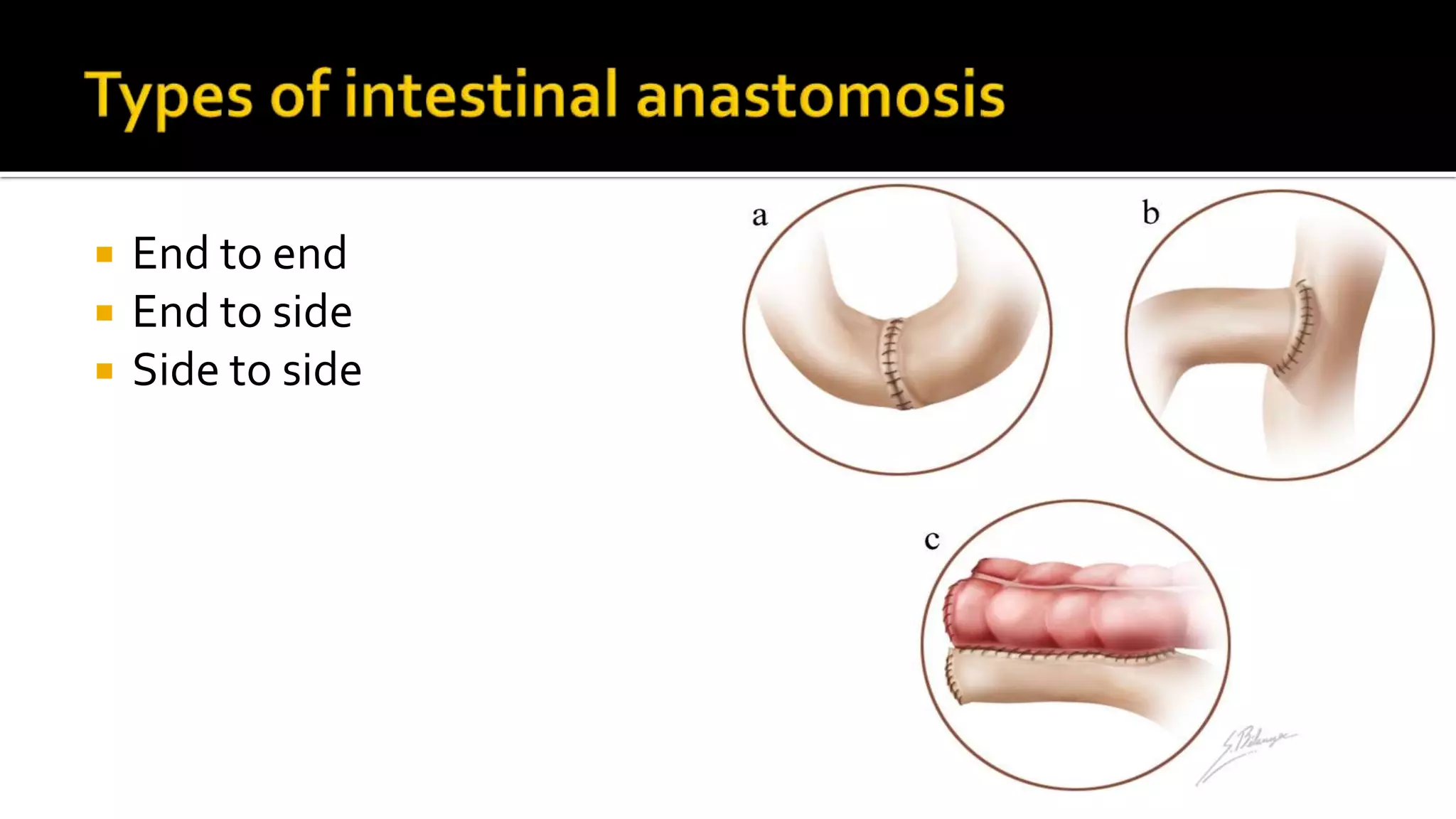 Bowel anastomosis | PPTX
