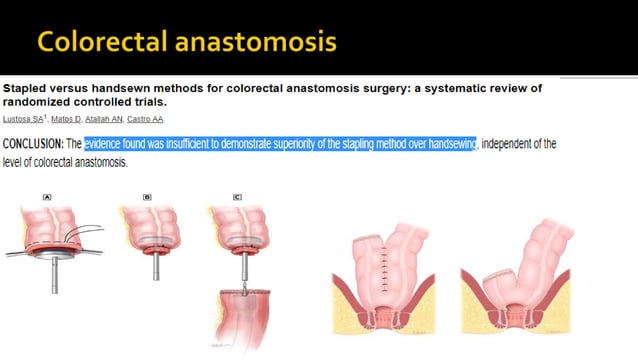 Bowel anastomosis | PPTX | Digestive Disorders | Diseases and Conditions