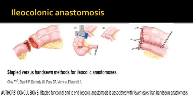 Bowel anastomosis