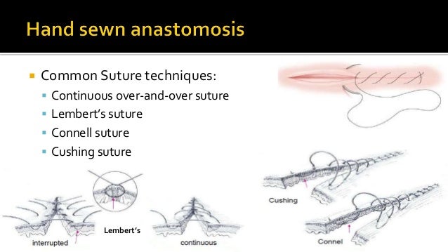 Bowel anastomosis