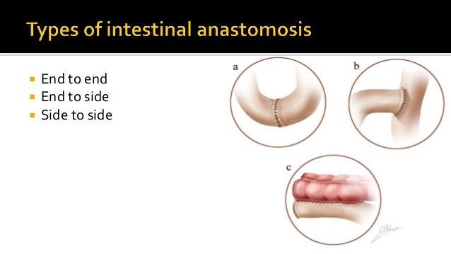 Bowel anastomosis